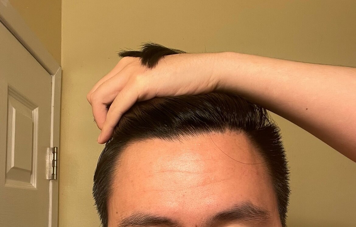 Hair Transplant Advice & Recommendation - Hair Restoration Questions ...