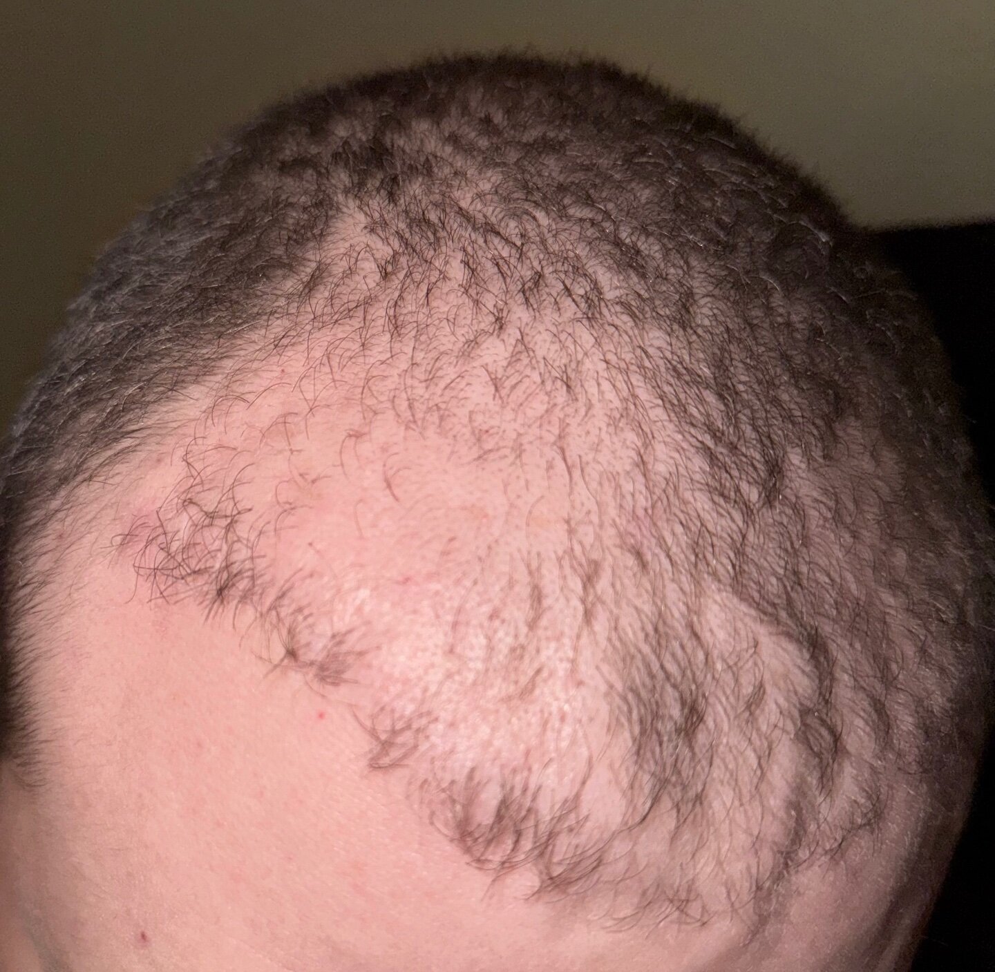 A warning to everyone considering Bosley for a hairtransplant. - Hair ...