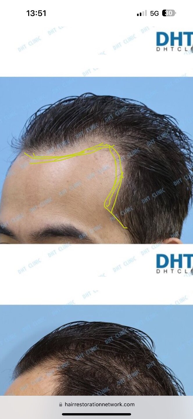 Restoring the fronto-temporal hairline - Results Posted by Leading Hair ...