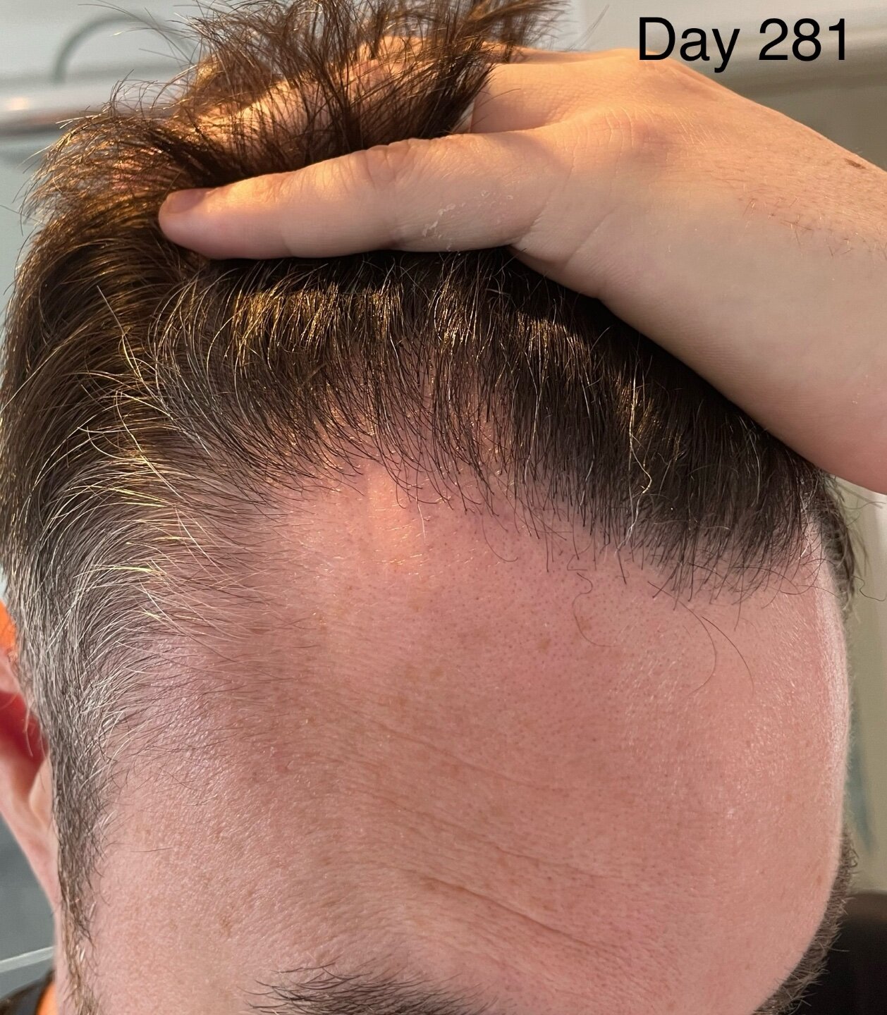 1500 Grafts, FUE - Farjo Hair Institute - Page 2 - Hair Transplant ...