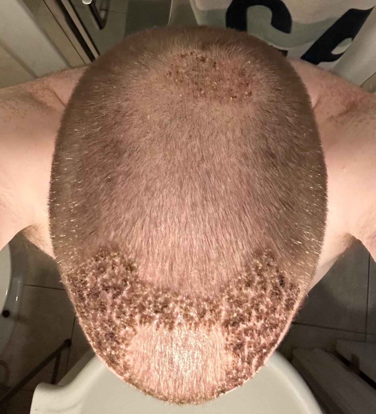 Diffusio/Thinning all on the top. - Hair Restoration Questions and ...