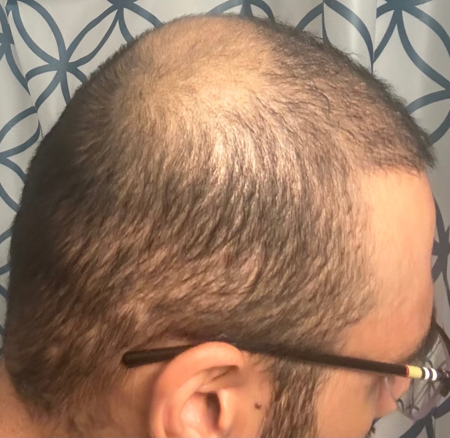 Eugenix | Dr Das | NW7 | 3500 grafts | March 2024 - Hair Transplant ...