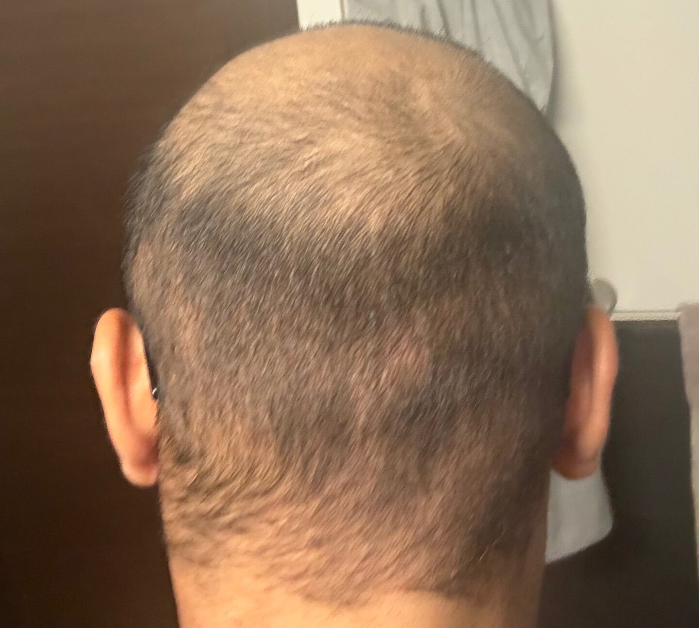 Eugenix | Dr Das | NW7 | 3500 grafts | March 2024 - Page 2 - Hair ...