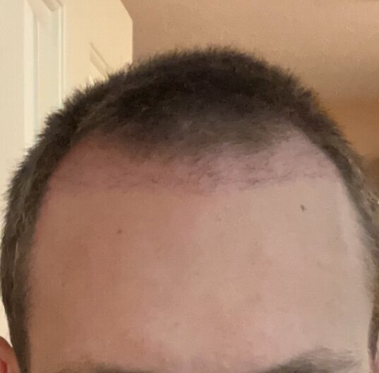 Extreme tightness in head 4 months after hair transplant. - Hair ...