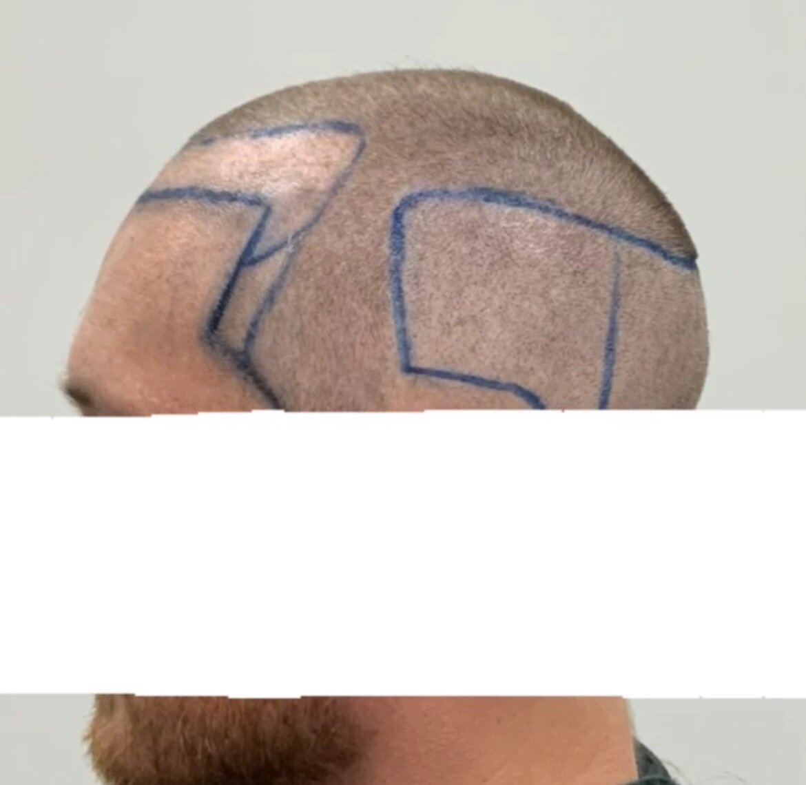 Extreme tightness in head 4 months after hair transplant. - Hair ...
