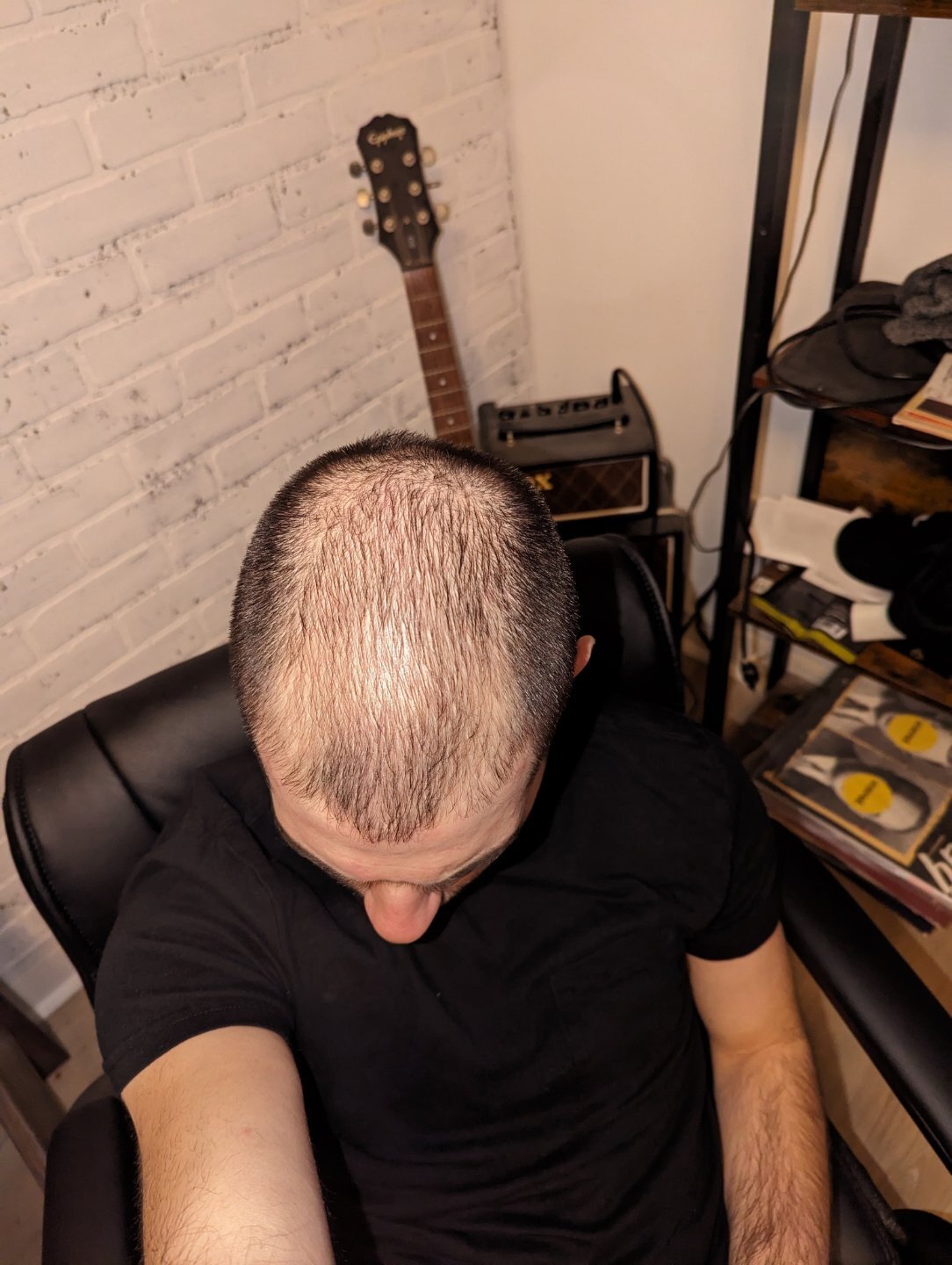 Pittella - 6875 Grafts (scalp only) - June 27th, 2024 - Hair Transplant ...