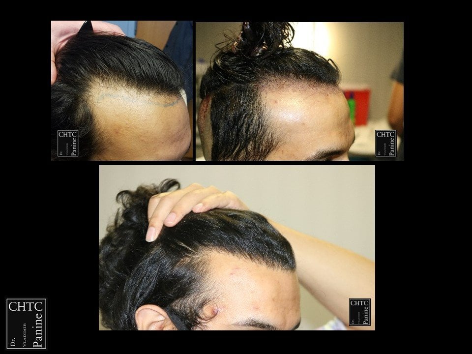 PANINE, MD | Chicago Hair Transplant Clinic | 2,500 Graft FUE Hair ...
