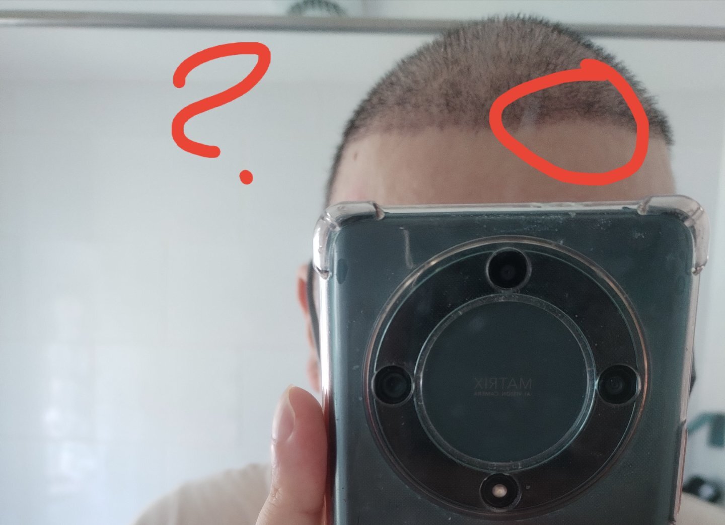 Hairline after hair transplant looks very uneven/wonky - Hair ...