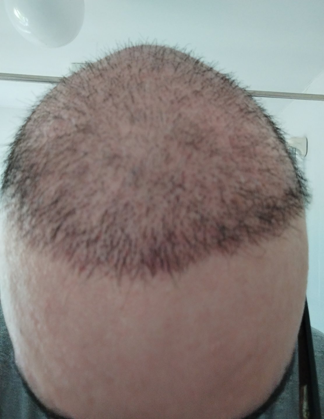Hairline after hair transplant looks very uneven/wonky - Hair ...