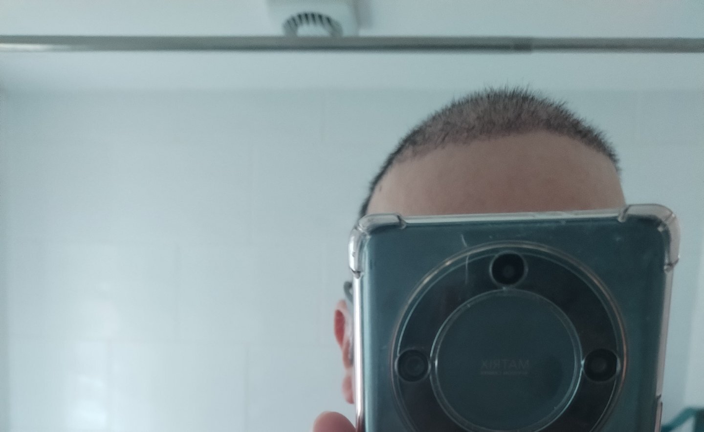 Hairline after hair transplant looks very uneven/wonky - Hair ...