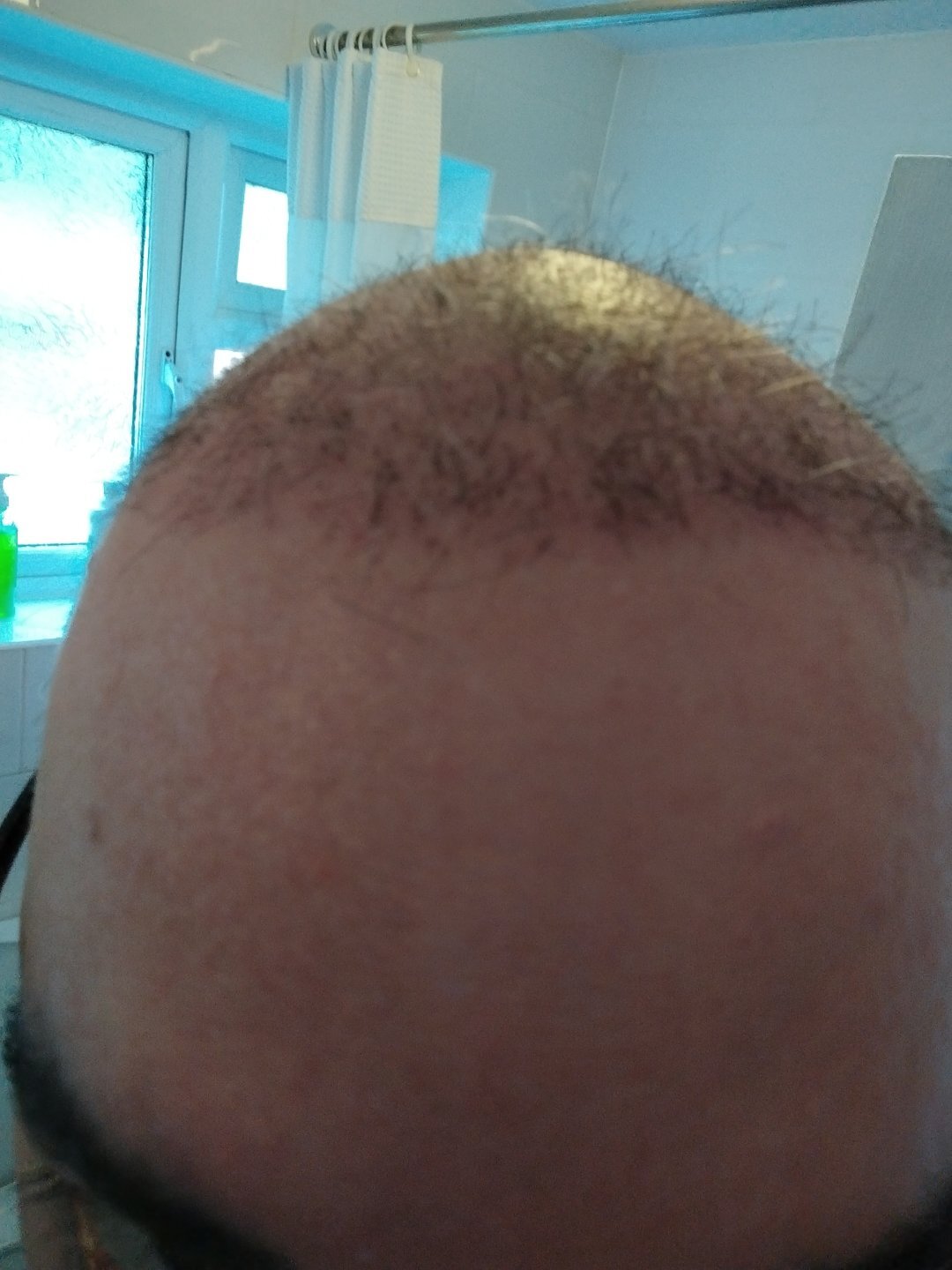 Hairline after hair transplant looks very uneven/wonky - Hair ...