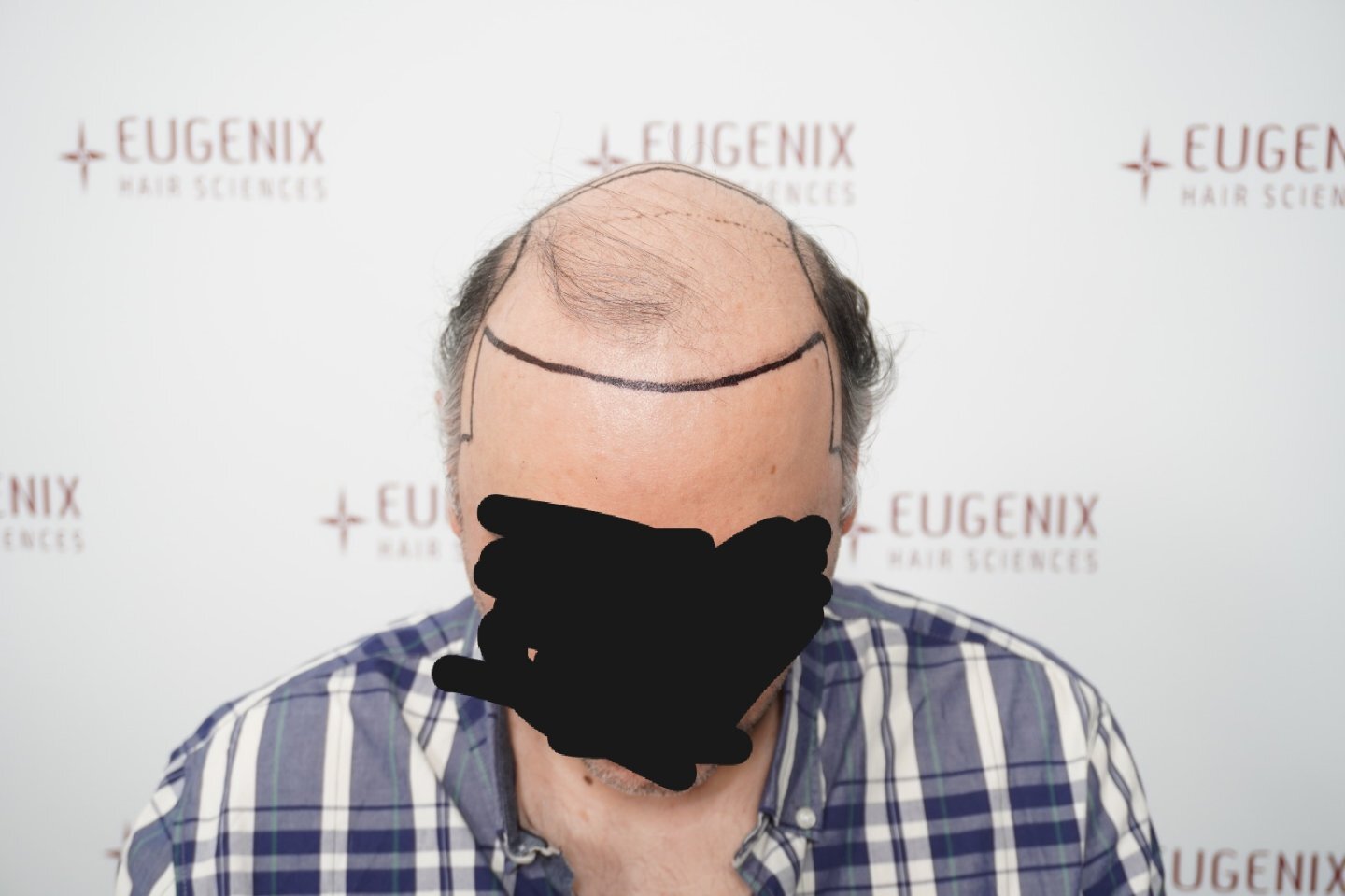 Hairline after hair transplant looks very uneven/wonky - Hair ...
