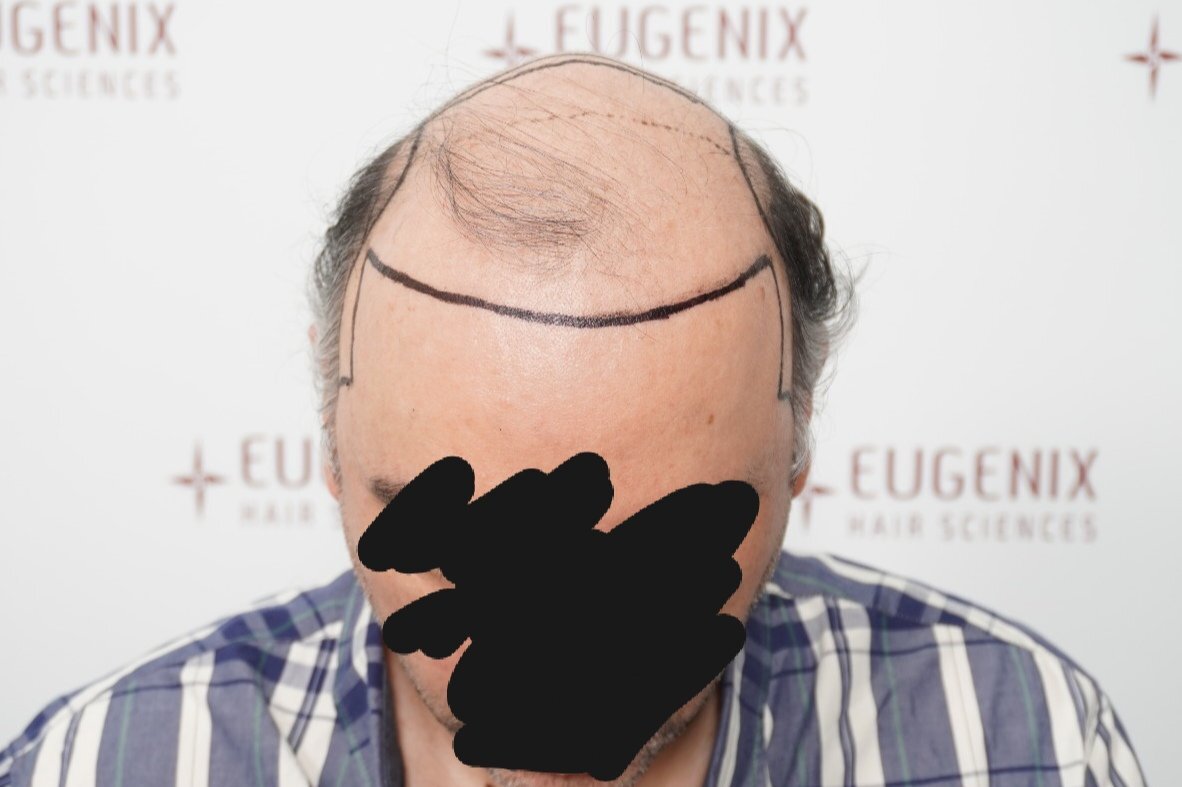 Hairline after hair transplant looks very uneven/wonky - Hair ...