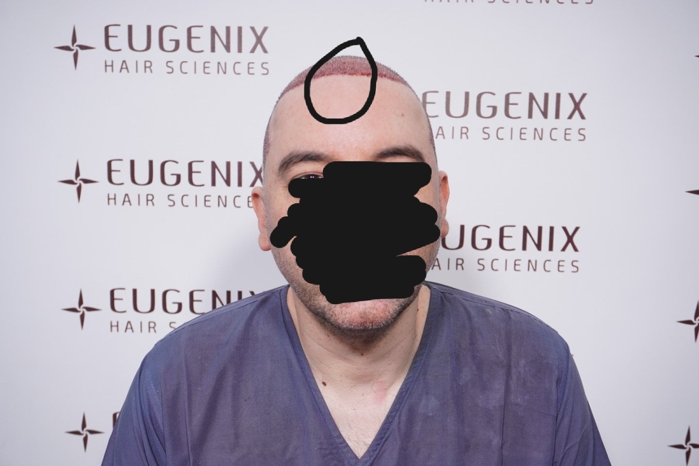 Hairline after hair transplant looks very uneven/wonky - Hair ...