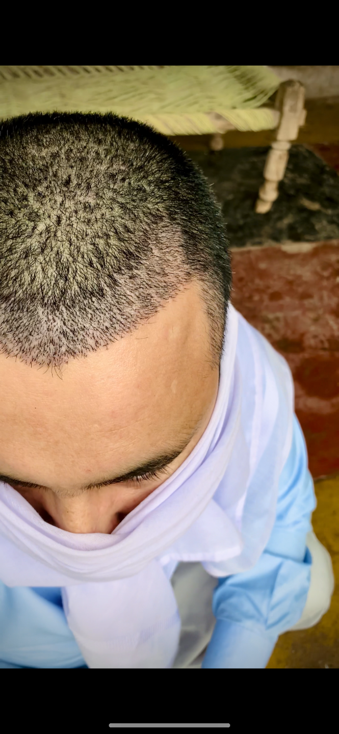 5 months & 12days of Ht scared ! - Hair Restoration Questions and ...