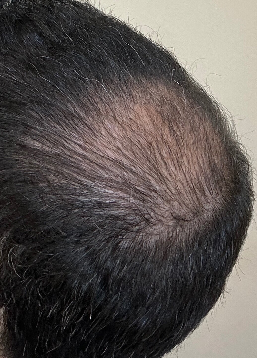 Dr. Bloxham - 2 FUTs + FUE temple points, 7350 grafts - Page 3 - Hair ...