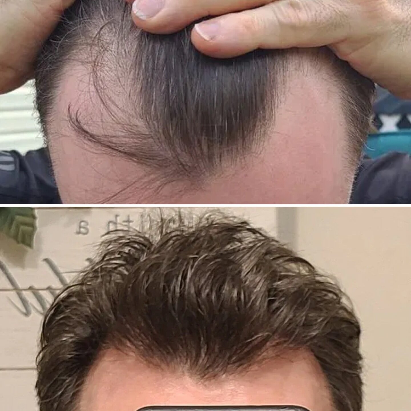 2450 FUE with Dr. Ron Shapiro/Dr. David Josephitis of Shapiro Medical ...