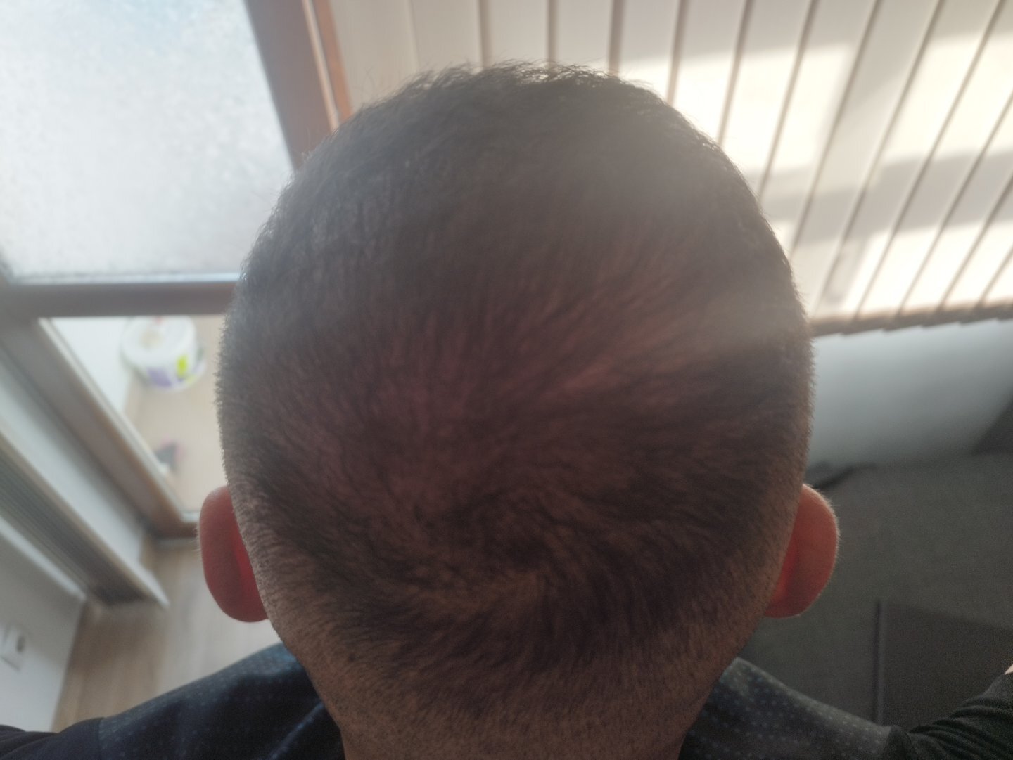 Crown HT Timeline? - Hair Restoration Questions and Answers - Hair ...