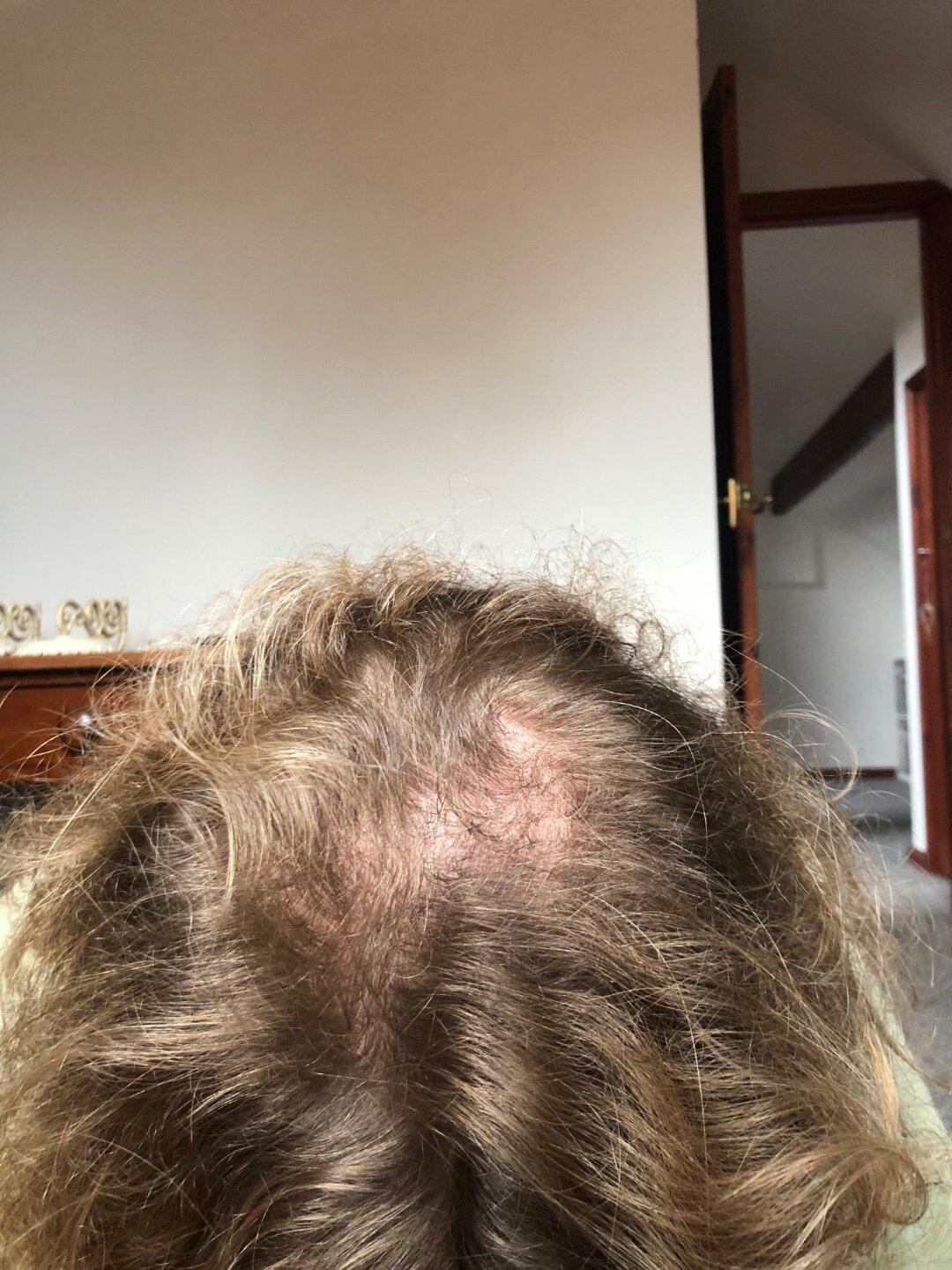 Long time hair loss sufferer, needs advice on next step/hair transplant ...