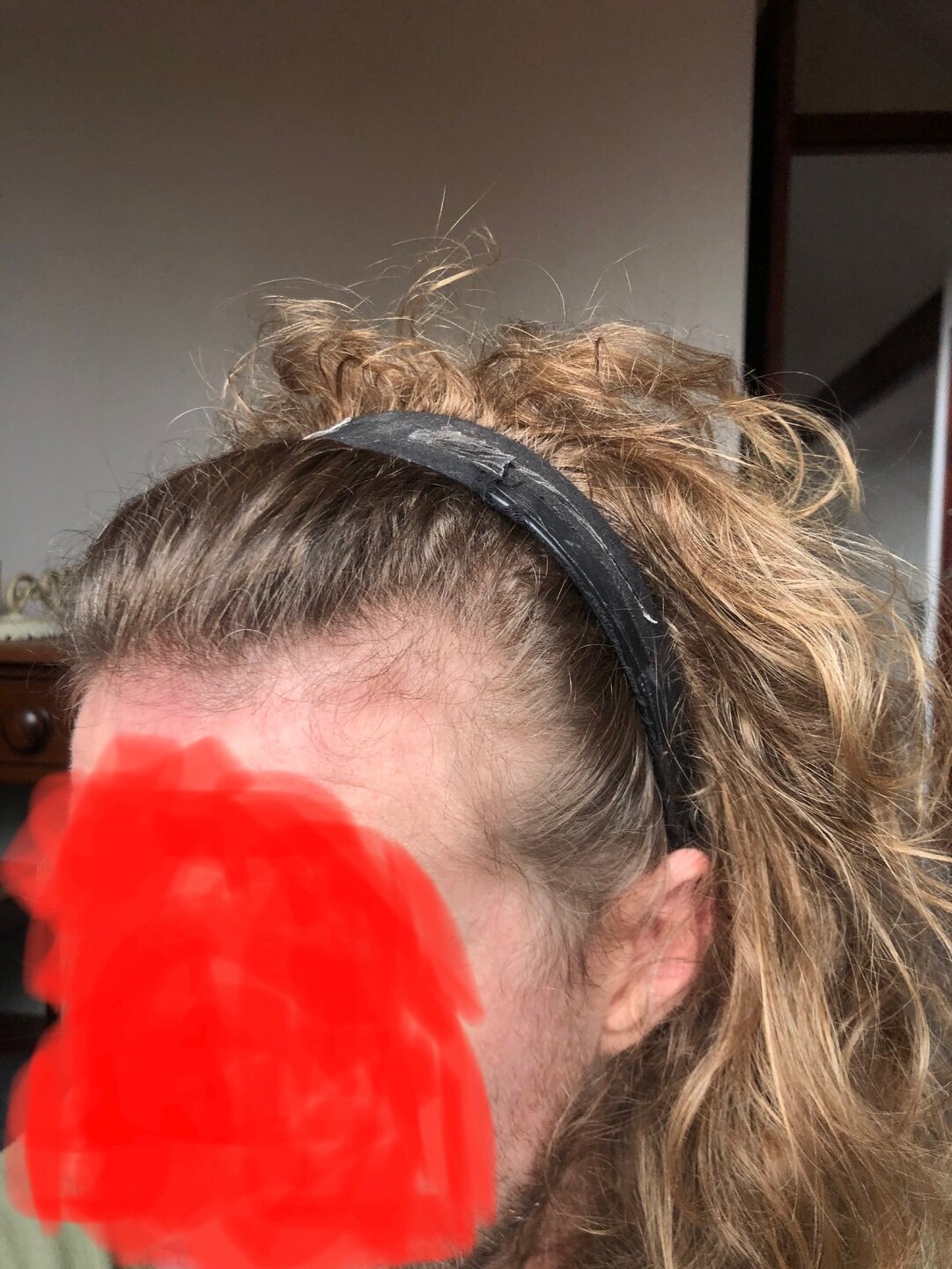 Long time hair loss sufferer, needs advice on next step/hair transplant ...