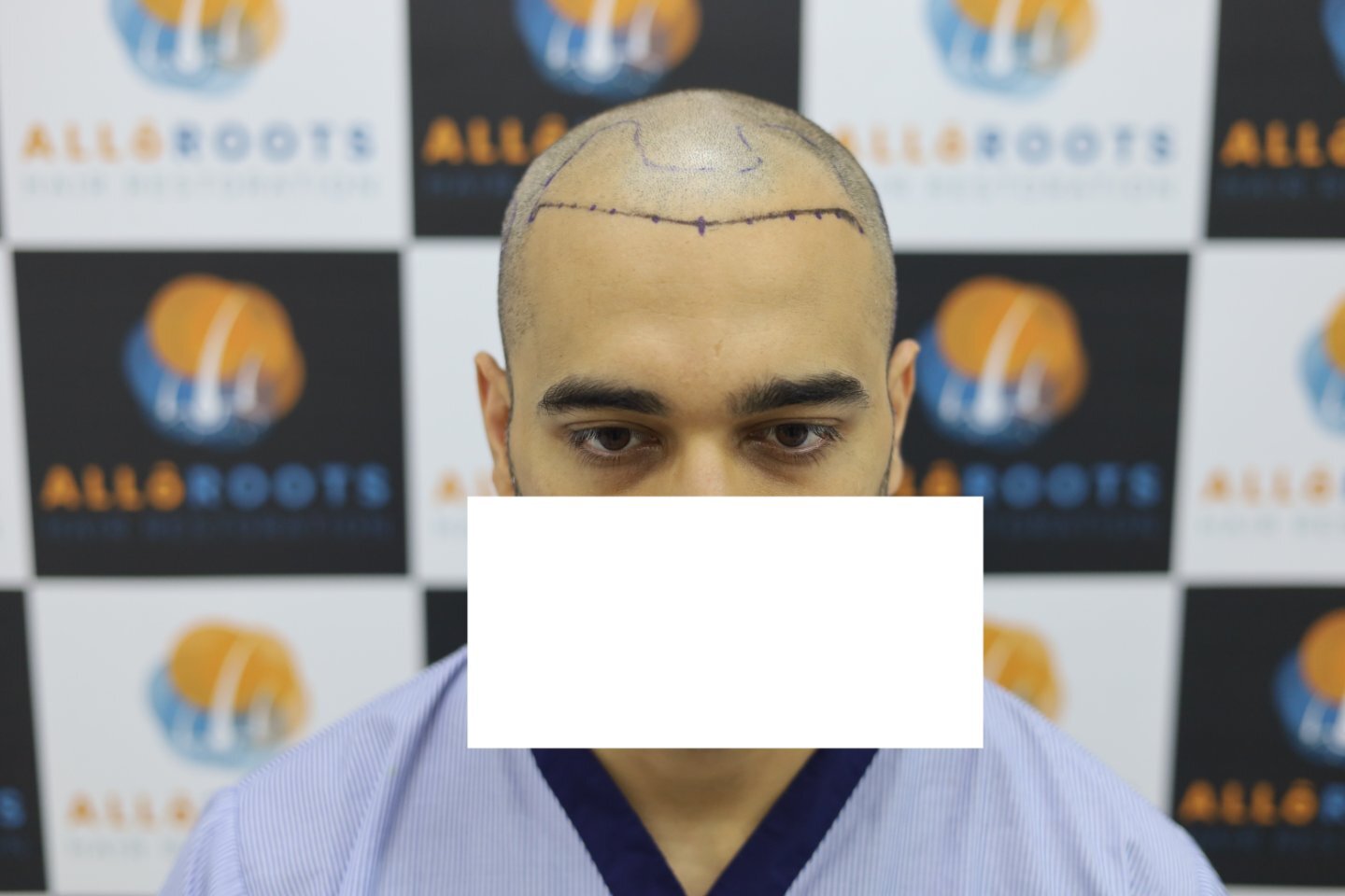 Dr. Alok Sahoo / Alloroots Delhi / 3042 Grafts FUE / 19 October 2024 ...