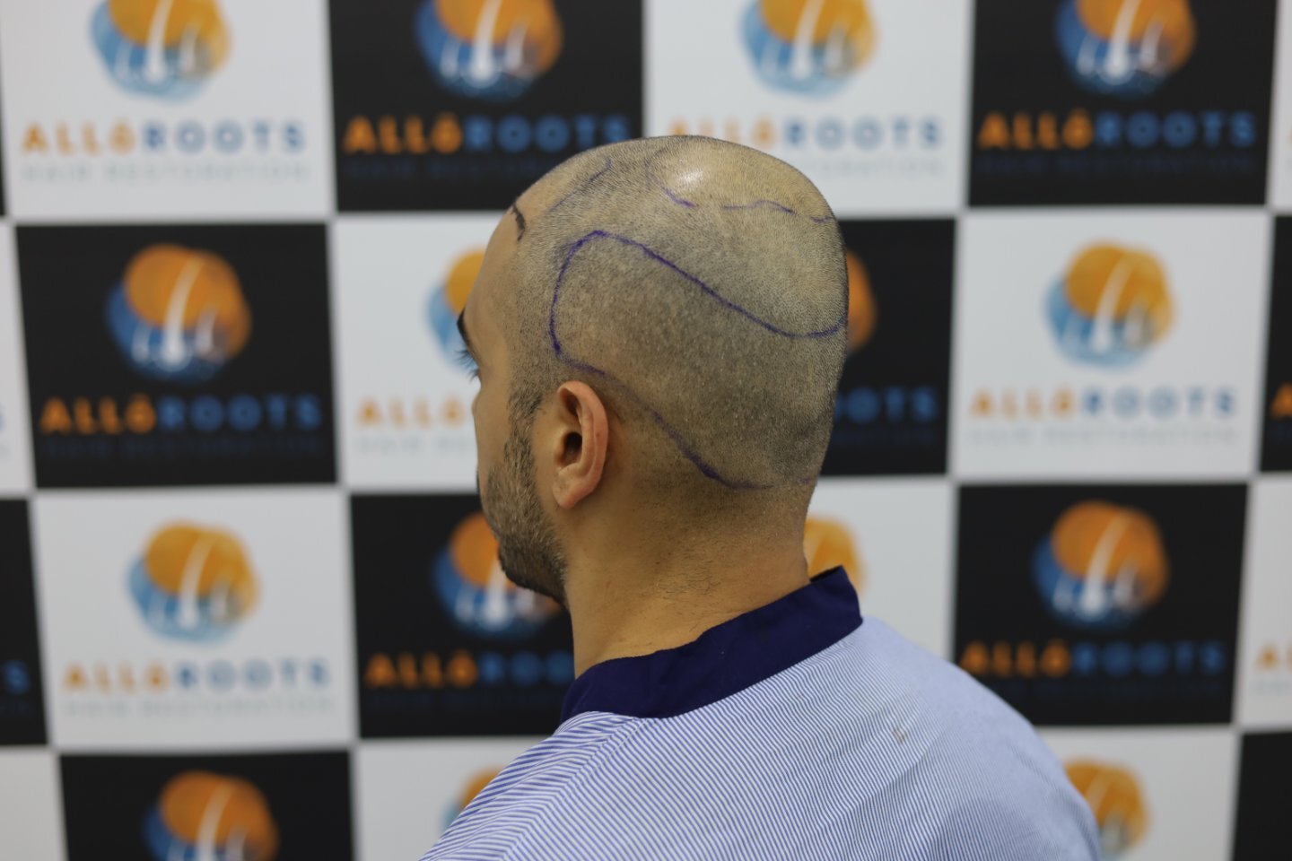 Dr. Alok Sahoo / Alloroots Delhi / 3042 Grafts FUE / 19 October 2024 ...