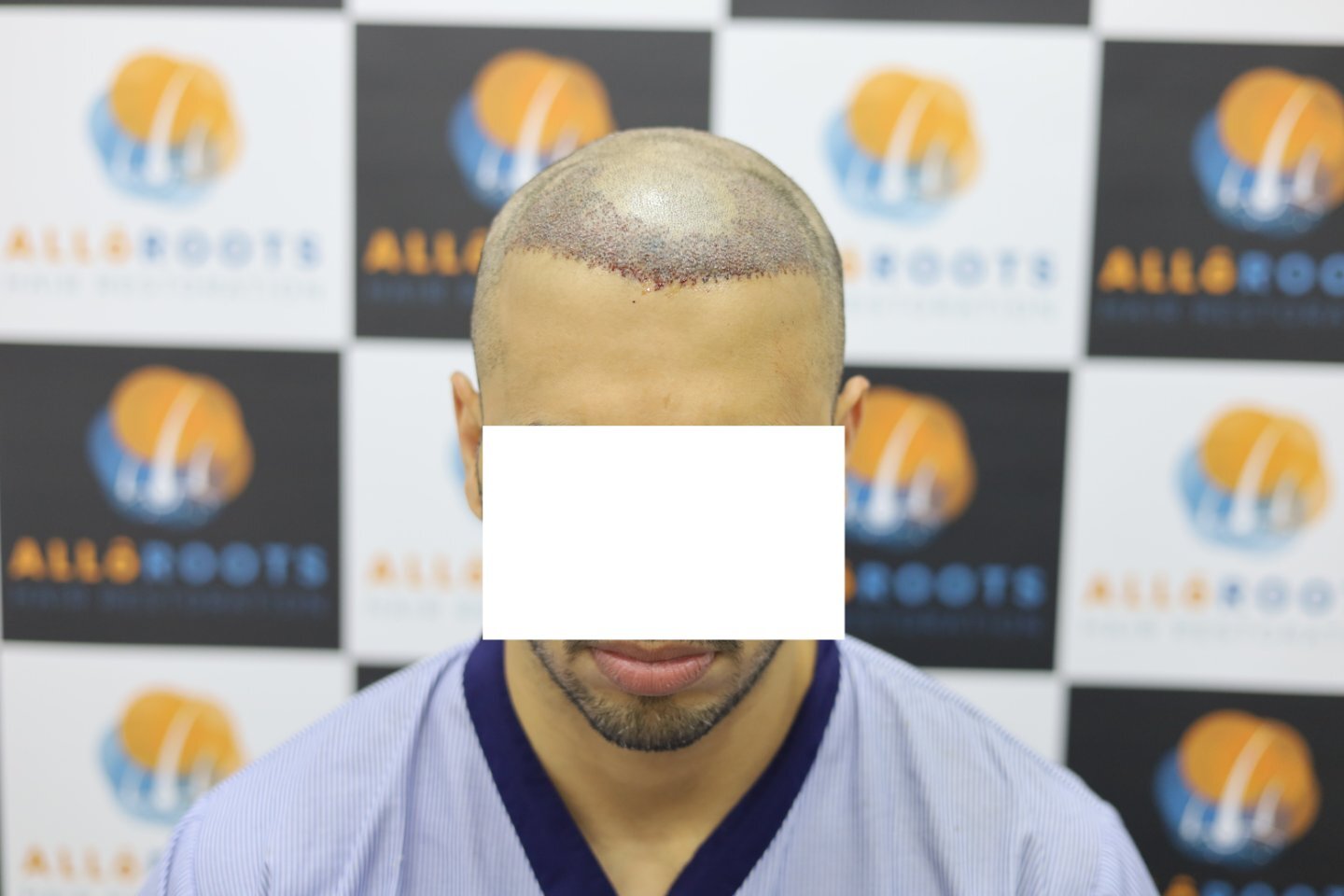 Dr. Alok Sahoo / Alloroots Delhi / 3042 Grafts FUE / 19 October 2024 ...