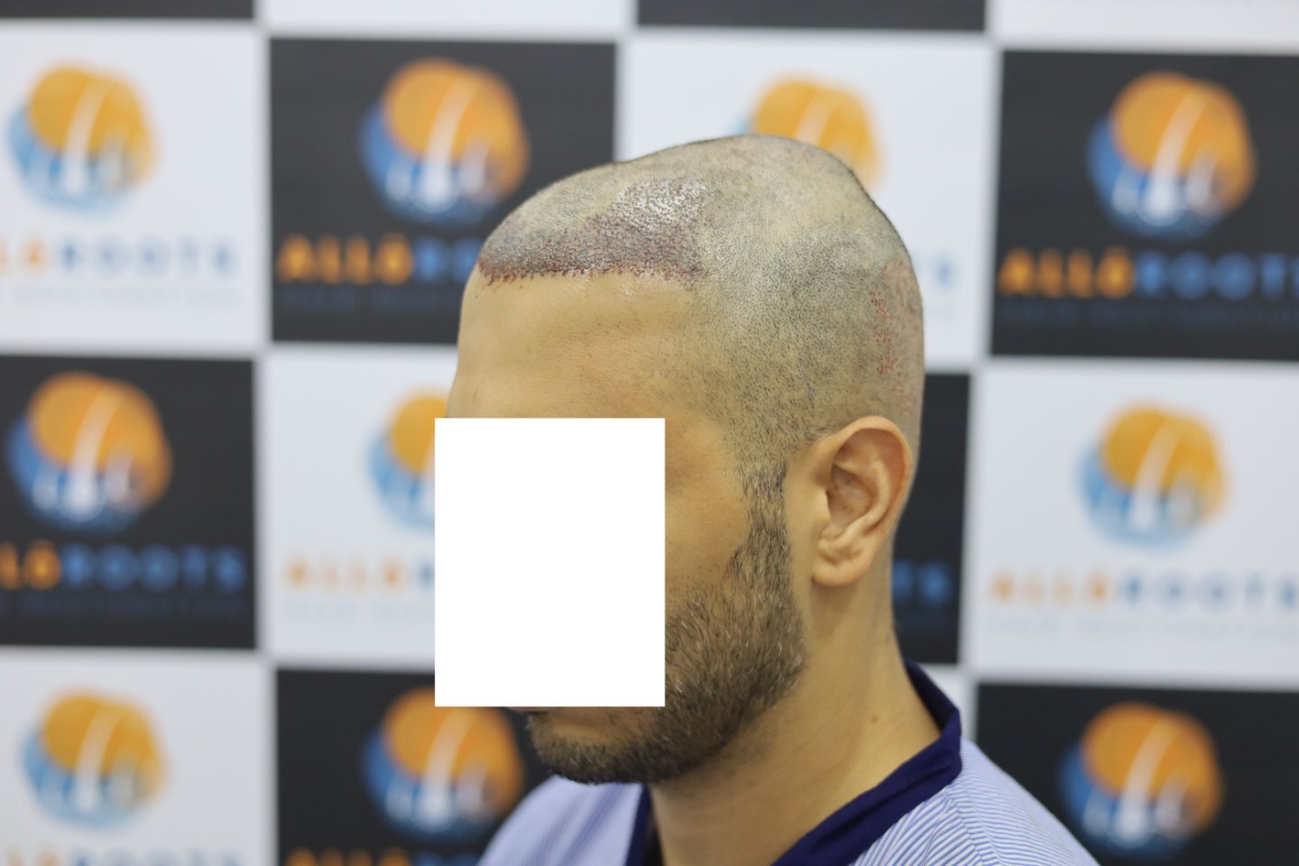 Dr. Alok Sahoo / Alloroots Delhi / 3042 Grafts FUE / 19 October 2024 ...