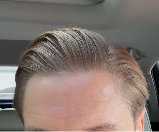 Small but ‘fairly aggressive’ hairline restoration | 901 grafts FUE | 4 ...