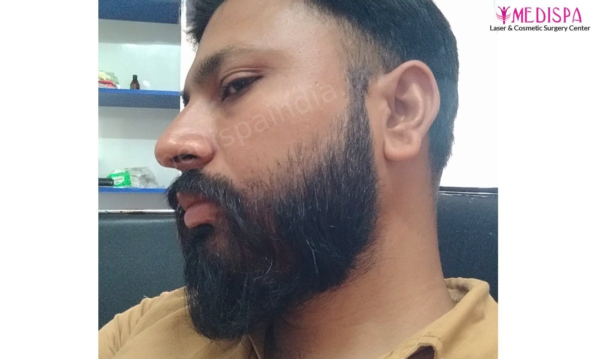Facial Burn Scar, Beard Reconstruction by Dr. Suneet Soni – 2704 Grafts ...