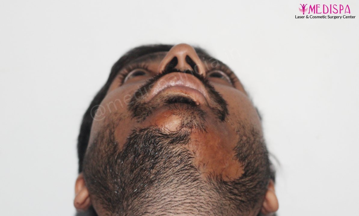 Facial Burn Scar, Beard Reconstruction by Dr. Suneet Soni – 2704 Grafts ...