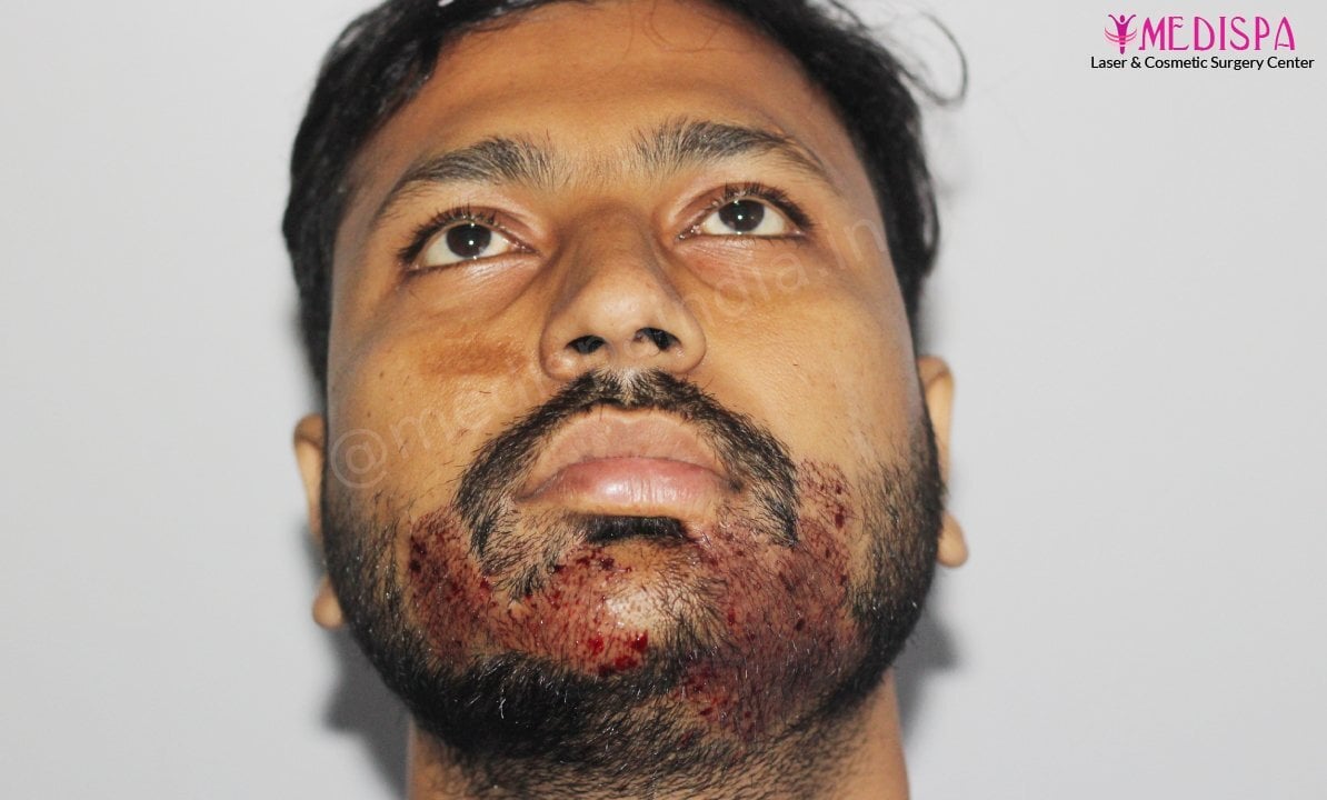 Facial Burn Scar, Beard Reconstruction by Dr. Suneet Soni – 2704 Grafts ...