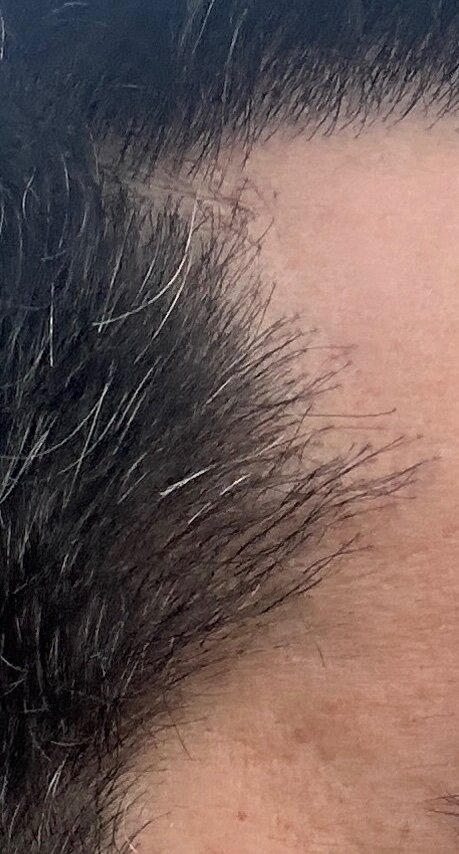Dr. Bloxham - 2 FUTs + FUE temple points, 7350 grafts - Page 4 - Hair ...