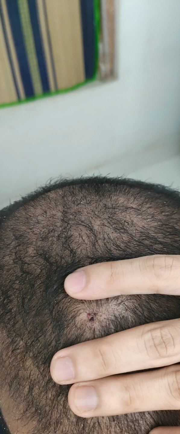 New scabs at 37 days post-op? - Hair Restoration Questions and Answers ...