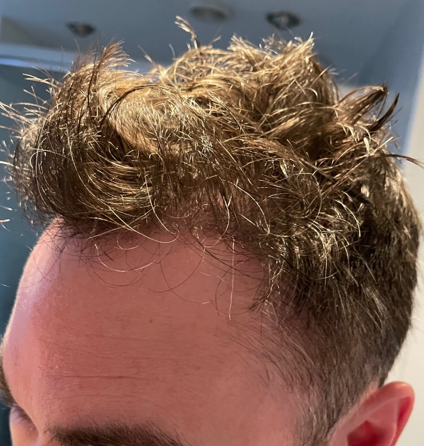 1500 Grafts, FUE - Farjo Hair Institute - Page 2 - Hair Transplant ...