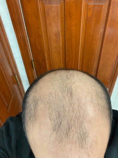 New to researching hair restoration, where do I begin? - Hair ...