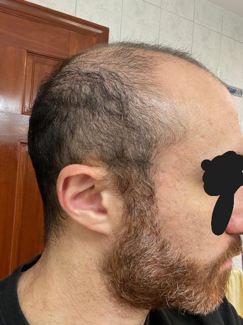 New to researching hair restoration, where do I begin? - Hair ...