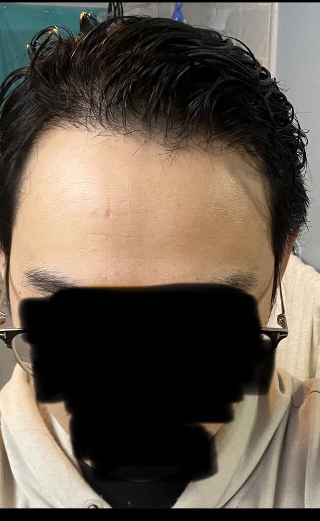 Going to have a surgery with Dr. Bloxham around 2000 grafts Hairline ...