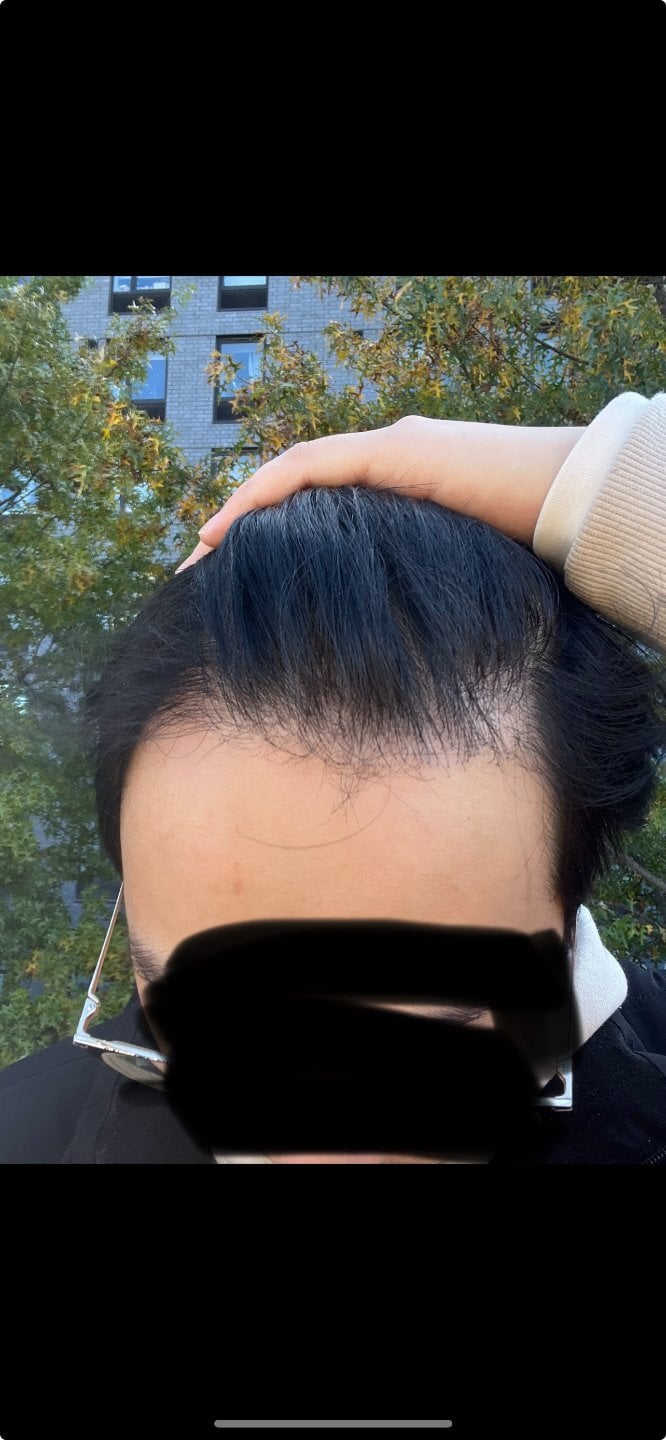 Going to have a surgery with Dr. Bloxham around 2000 grafts Hairline ...