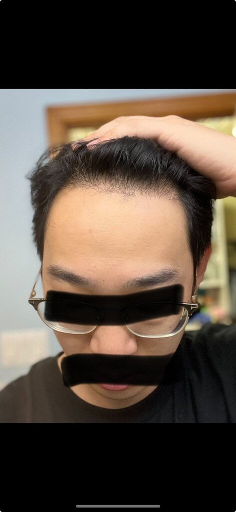 Going to have a surgery with Dr. Bloxham around 2000 grafts Hairline ...