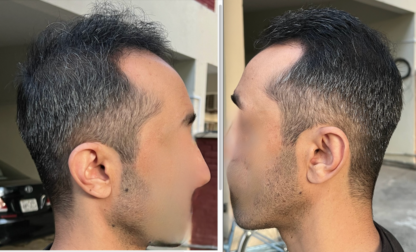 How many Grafts do I really need for Frontal and Crown? - Hair ...
