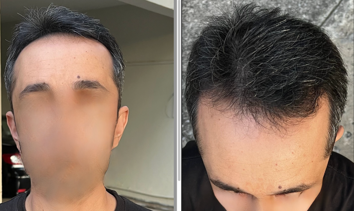 How many Grafts do I really need for Frontal and Crown? - Hair ...
