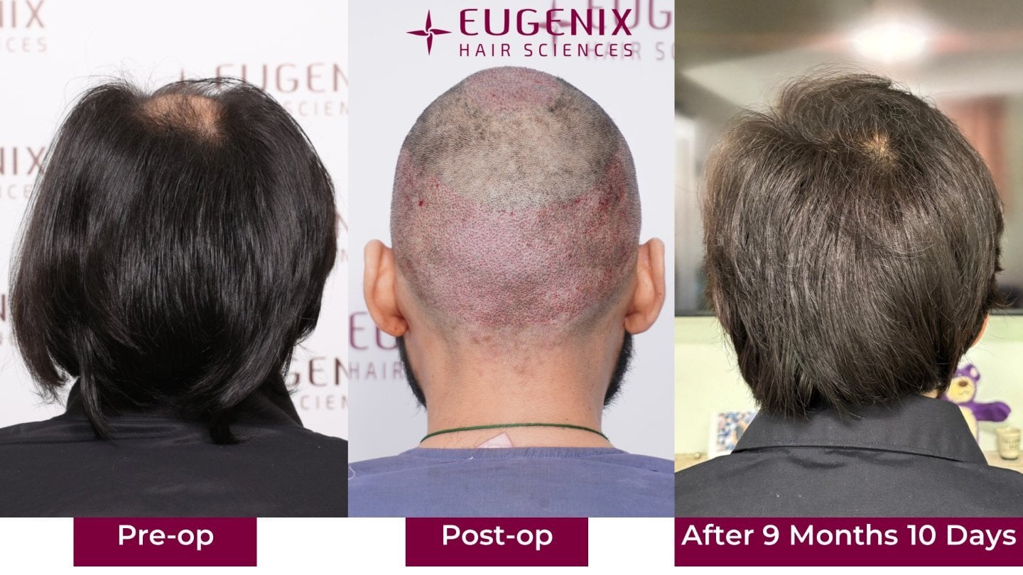 Eugenix Hair Sciences | NW 6 | 3,534 Grafts | 9 Months Hair Transplant ...