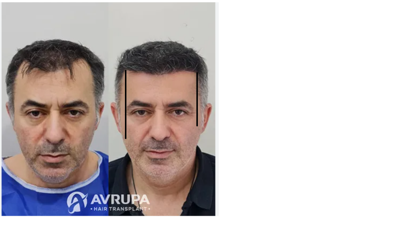 Frontal Temporal Angle - Hair Restoration Questions and Answers - Hair ...