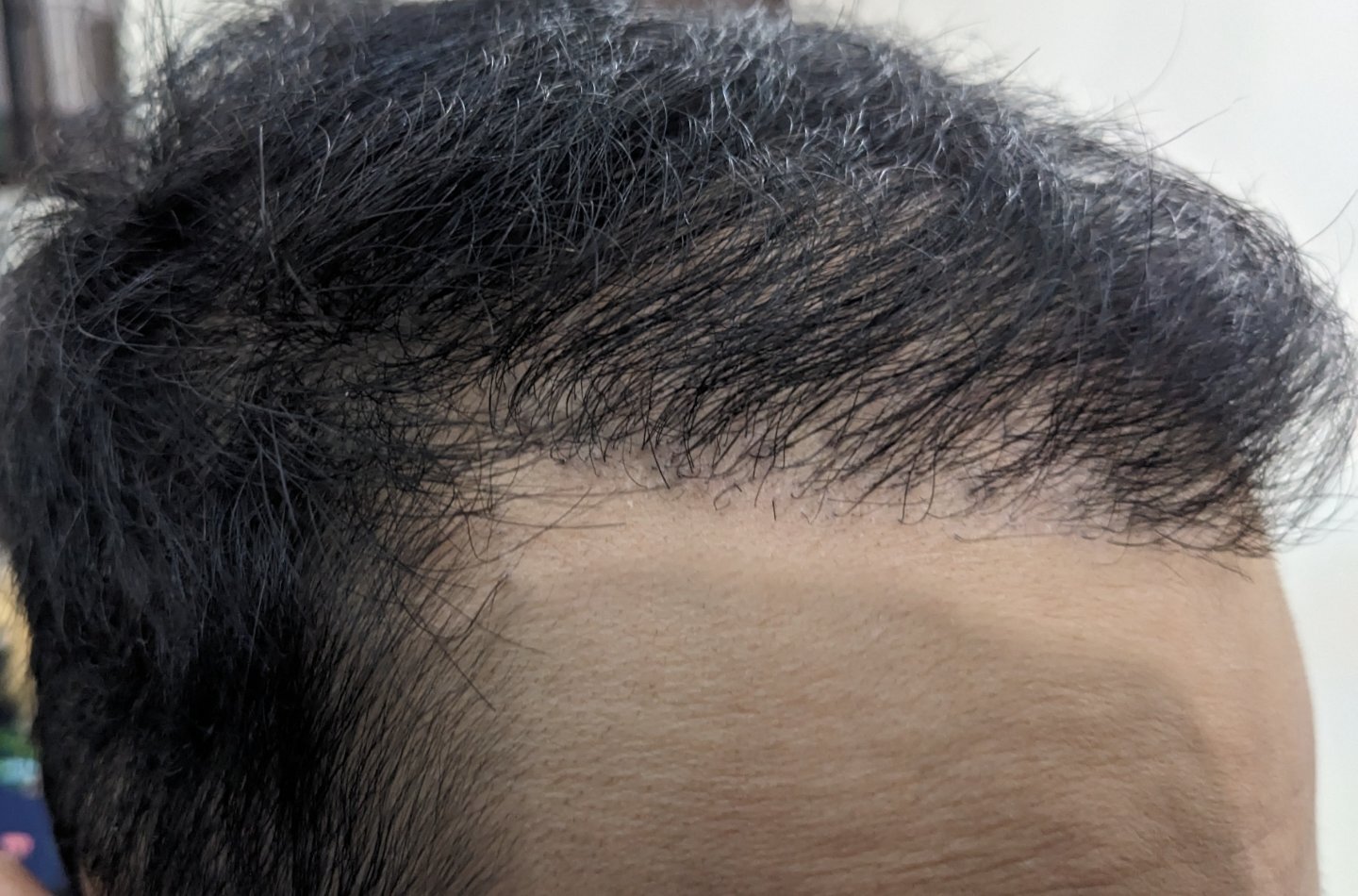 Disappointed with 6-Month Hair Transplant Results - Hair Restoration ...