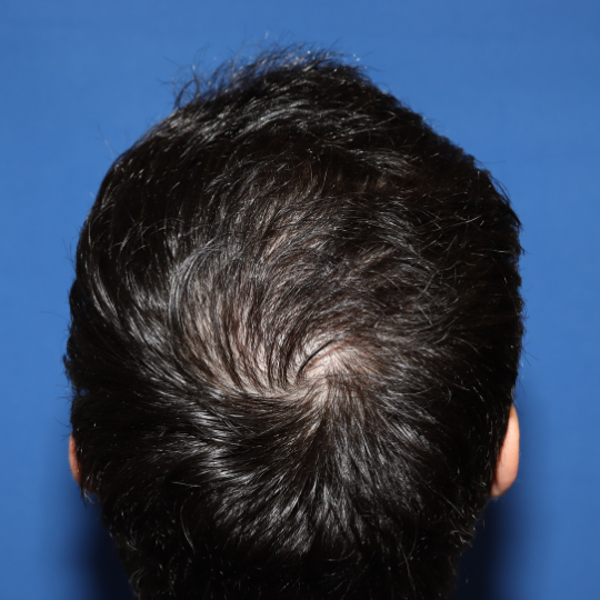 Dr. Bhumik Shah (New Jersey) - 1550 FU grafts to treat vertex baldness ...