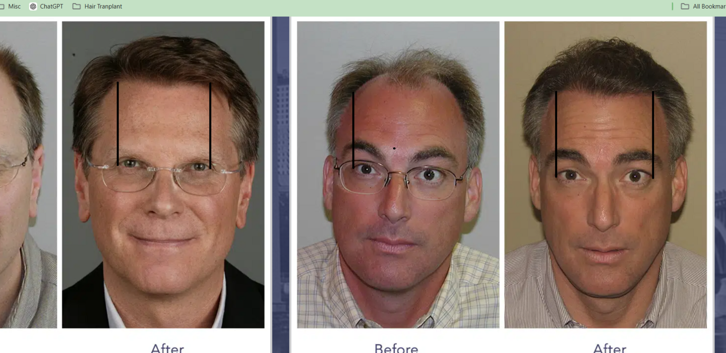 Frontal Temporal Angle - Hair Restoration Questions and Answers - Hair ...