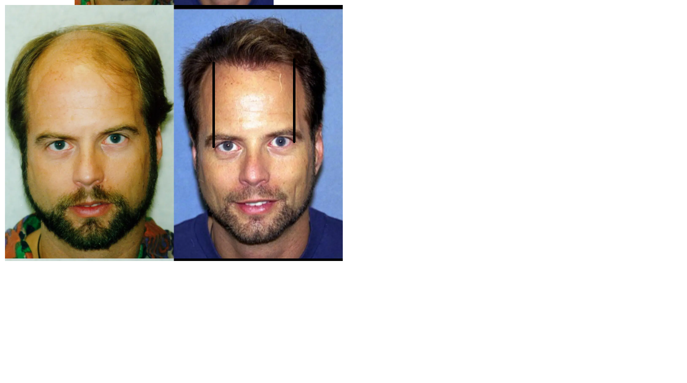 Frontal Temporal Angle - Hair Restoration Questions and Answers - Hair ...