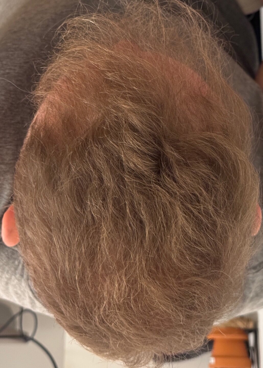 2500 grafts - Dr Bisanga - failed or mediocre result? - 4 years later ...