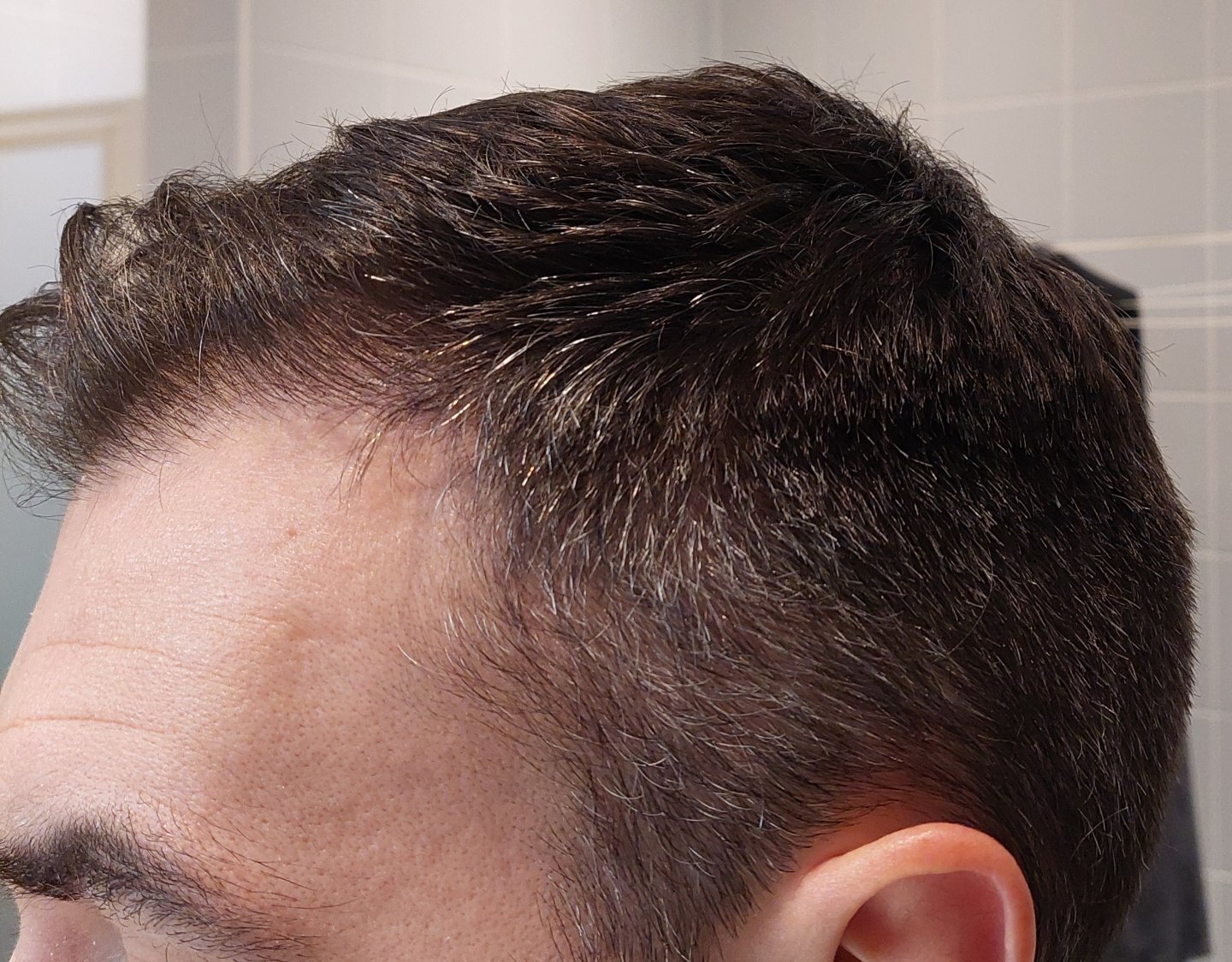 Seeking Advice for 2nd Hair Transplant: Budget €7-8K, Focus on Density ...